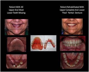 Complete And Removable Partial Dentures | Best Dental Treatment for ...